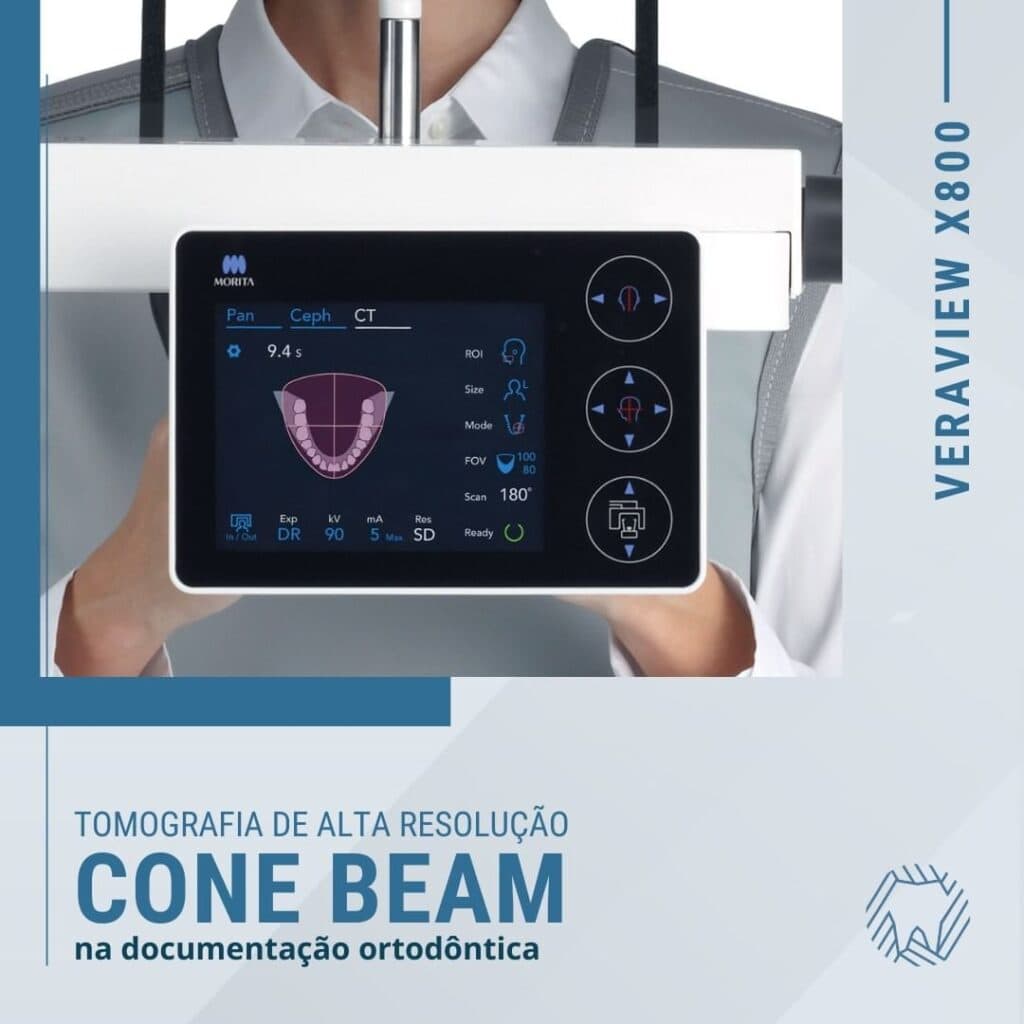 TOMOGRAFIA DE ALTA RESOLUÇÃO: CONE BEAM NA DOCUMENTAÇÃO ORTODÔNTICA ...