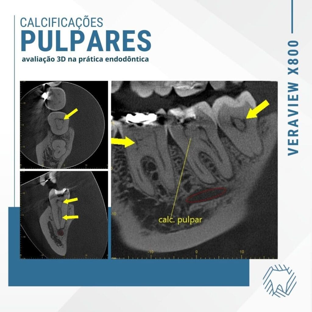 CALCIFICAÇÕES PULPARES:AVALIAÇÃO 3D NA PRÁTICA ENDODÔNTICA - Studio RX