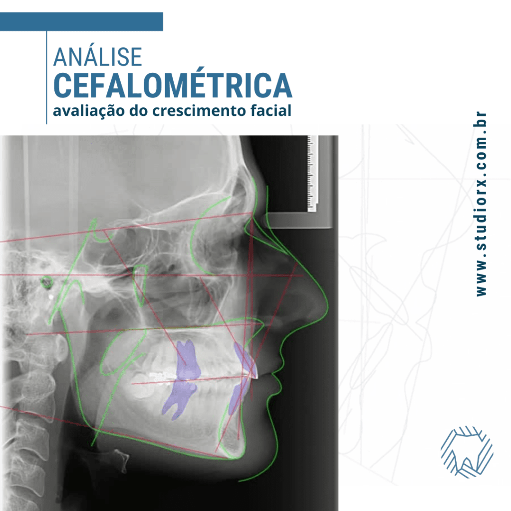 ANÁLISE CEFALOMÉTRICA - Studio RX