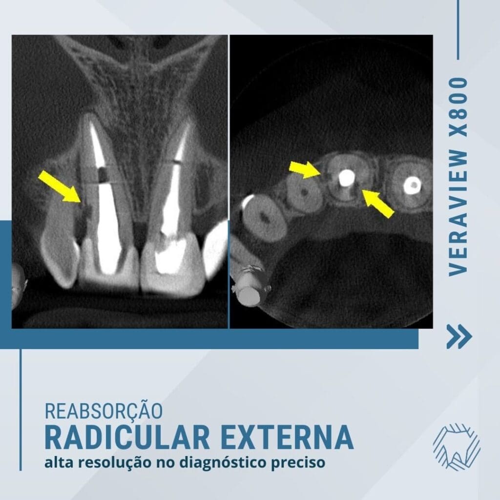 REABSORÇÃO RADICULAR EXTERNA - Studio RX