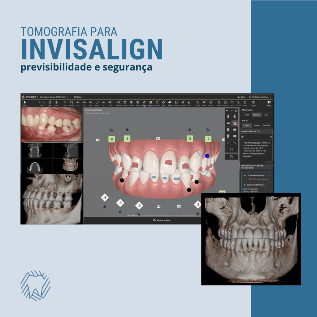 TOMOGRAFIA PARA INVISALIGN - Studio RX