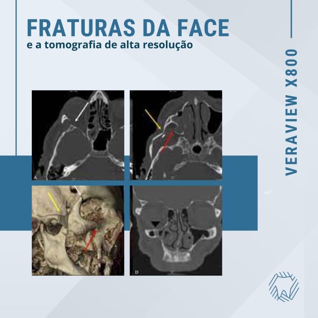 FRATURAS DA FACE E A TOMOGRAFIA DE ALTA RESOLUÇÃO - Studio RX