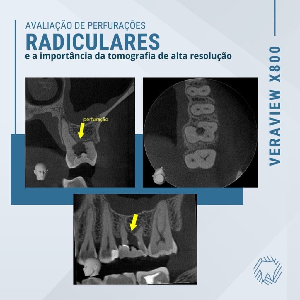 AVALIAÇÃO DE PERFURAÇÕES RADICULARES E A IMPORTÂNCIA DA TOMOGRAFIA DE ...
