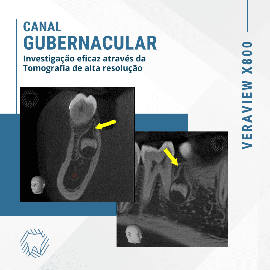 Canal Gubernacular - Studio RX