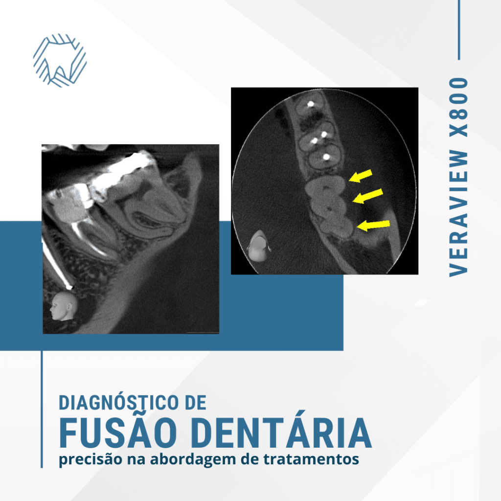 Diagnóstico de Fusão Dentária - Studio RX